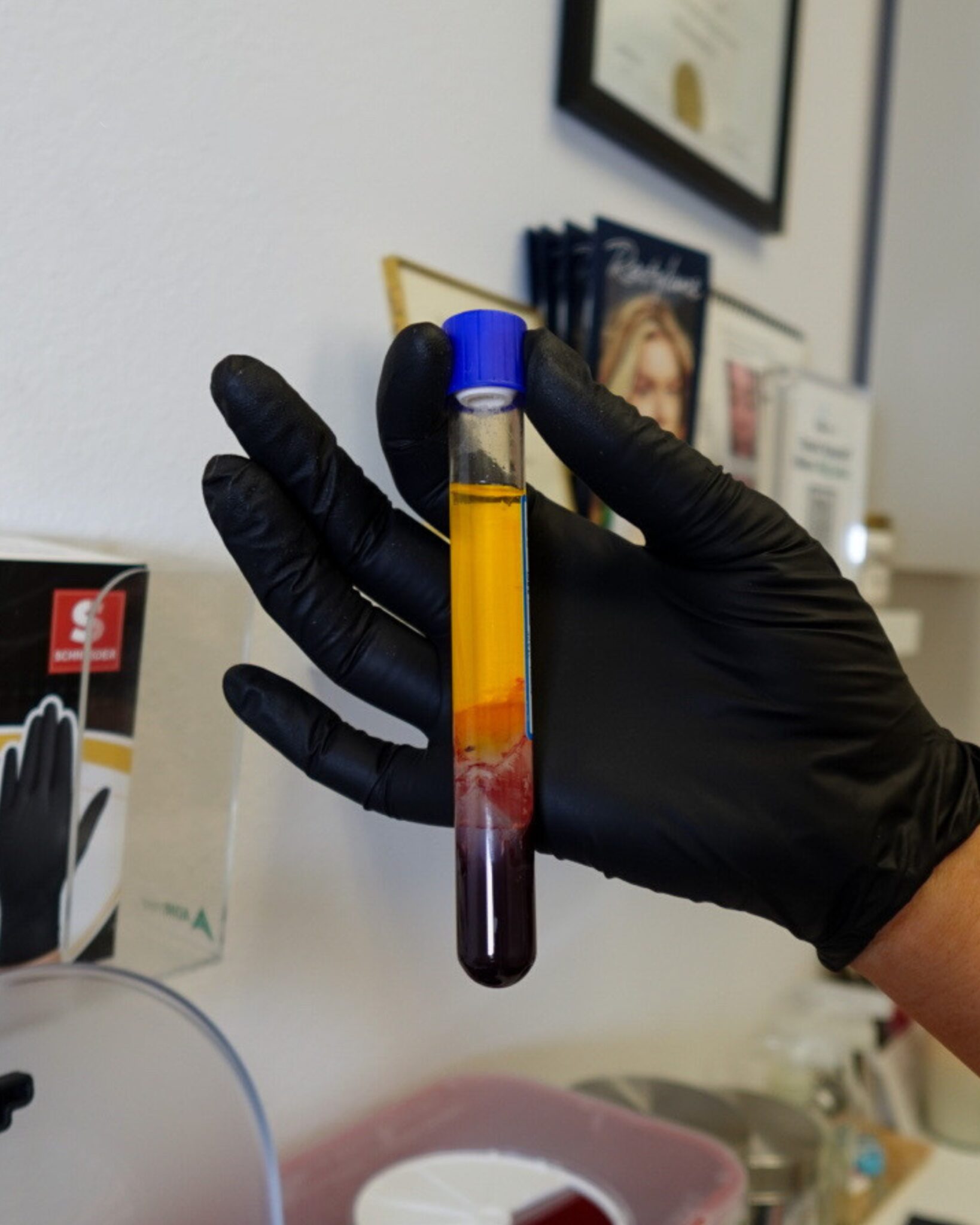 PRP Platelet-Rich Plasma - Injections By Eliza